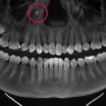 supernumerary-1 - Decisions in Dentistry