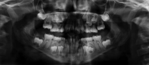 Correcting Bilateral Ectopically Erupting First Molars - Decisions in ...