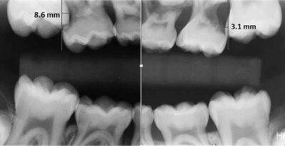 Correcting Bilateral Ectopically Erupting First Molars - Decisions in ...