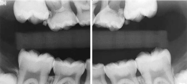 Correcting Bilateral Ectopically Erupting First Molars - Decisions in ...