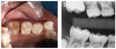 Correcting Bilateral Ectopically Erupting First Molars - Decisions in ...