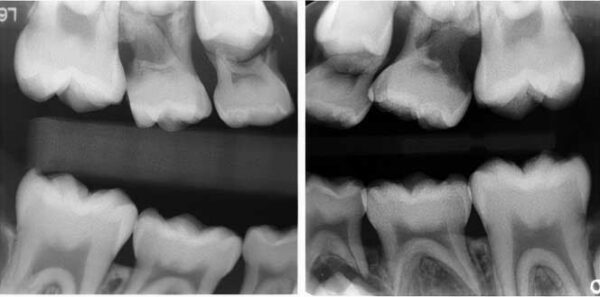 Correcting Bilateral Ectopically Erupting First Molars - Decisions in ...
