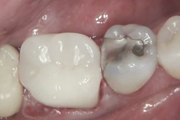 Using Endodontic Therapy And an Endocrown to Treat Patients on ...