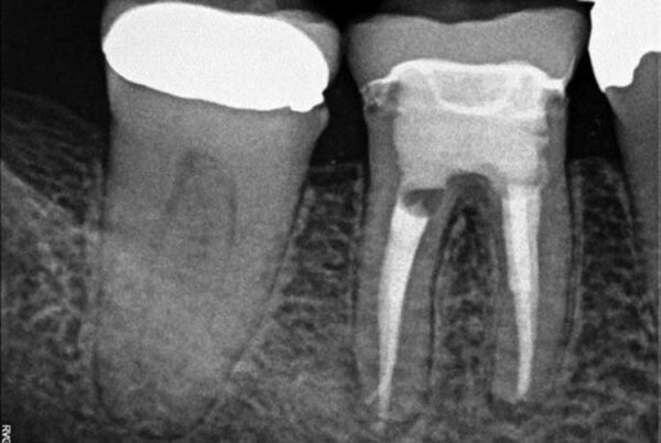 Using Endodontic Therapy And an Endocrown to Treat Patients on ...