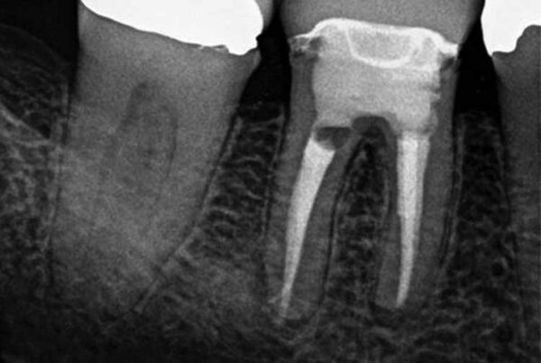 Using Endodontic Therapy And an Endocrown to Treat Patients on ...