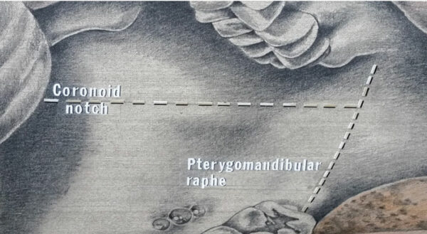 Three Techniques for Mandibular Block Anesthesia - Decisions in Dentistry