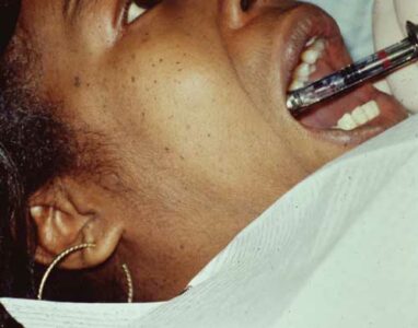 Three Techniques for Mandibular Block Anesthesia - Decisions in Dentistry