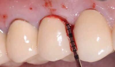 Evolving Management of Peri-Implant Disease - Decisions in Dentistry