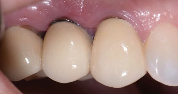 Evolving Management of Peri-Implant Disease - Decisions in Dentistry