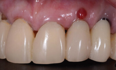 Overcoming Soft Tissue Complications During Implant Restoration ...