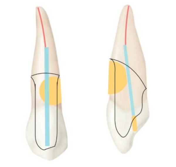 Multidisciplinary Management of Invasive Cervical Resorption ...