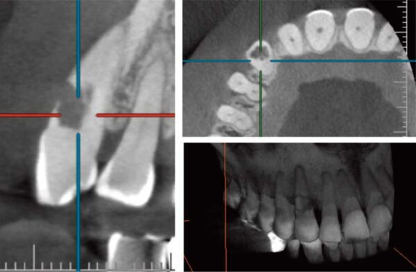 Multidisciplinary Management of Invasive Cervical Resorption ...