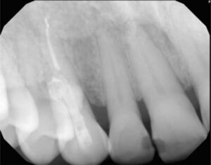 Multidisciplinary Management of Invasive Cervical Resorption ...