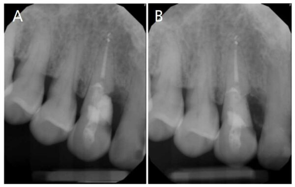 Multidisciplinary Management of Invasive Cervical Resorption ...
