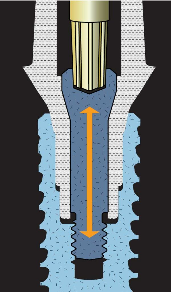7 Habits of Highly Effective Implant Clinicians - Decisions in Dentistry