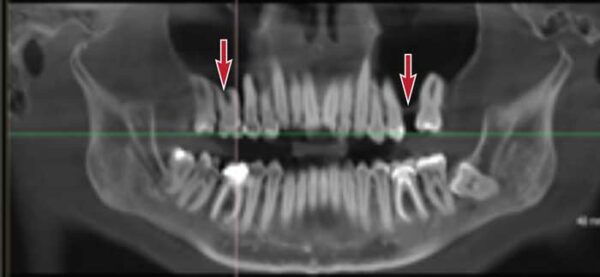 Extensive Maxillary Sinus Pneumatization: A Clinico- Radiological Case ...