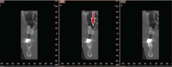Extensive Maxillary Sinus Pneumatization: A Clinico- Radiological Case ...