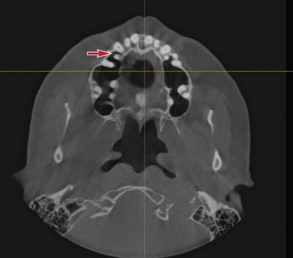 Extensive Maxillary Sinus Pneumatization A Clinico Radiological Case