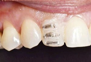 Optimizing Esthetics With a Single Veneer - Decisions in Dentistry
