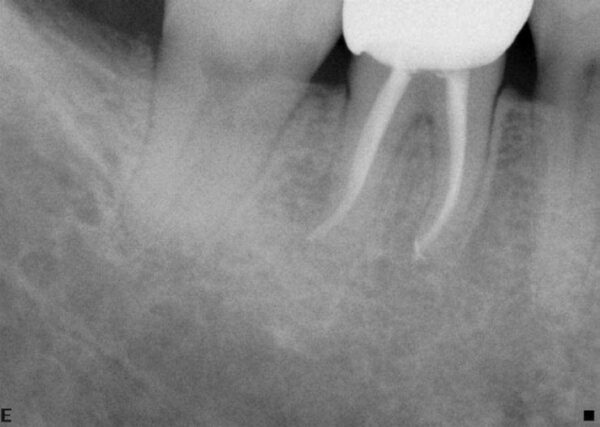 Diagnosis of Endodontic-Periodontal Lesions - Decisions in Dentistry