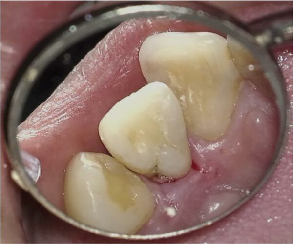 Diagnosis of Endodontic-Periodontal Lesions - Decisions in Dentistry
