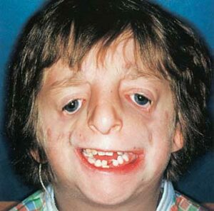 Oral Health Impacts of Treacher Collins Syndrome - Decisions in Dentistry