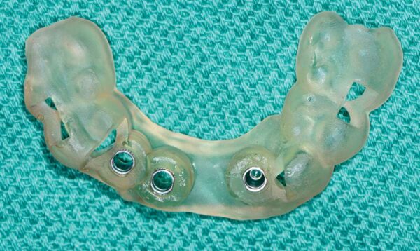 Improve Outcomes by Digitizing Implant Workflows - Decisions in Dentistry