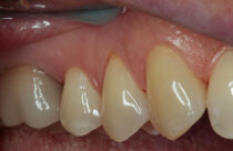 Clinical Treatment of Deep Caries - Decisions in Dentistry