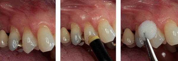Preventing Oral Diseases With Biomimetic Hydroxyapatite - Decisions in ...