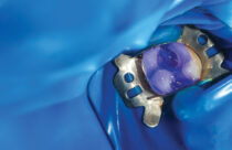 10 Steps to Rubber Dam Isolation in Restorative Therapy