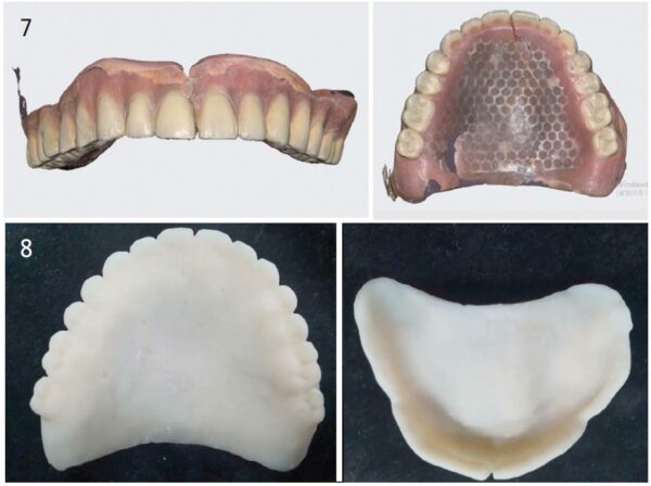 Intraoral Scanning in the Creation and Application of Duplicate ...