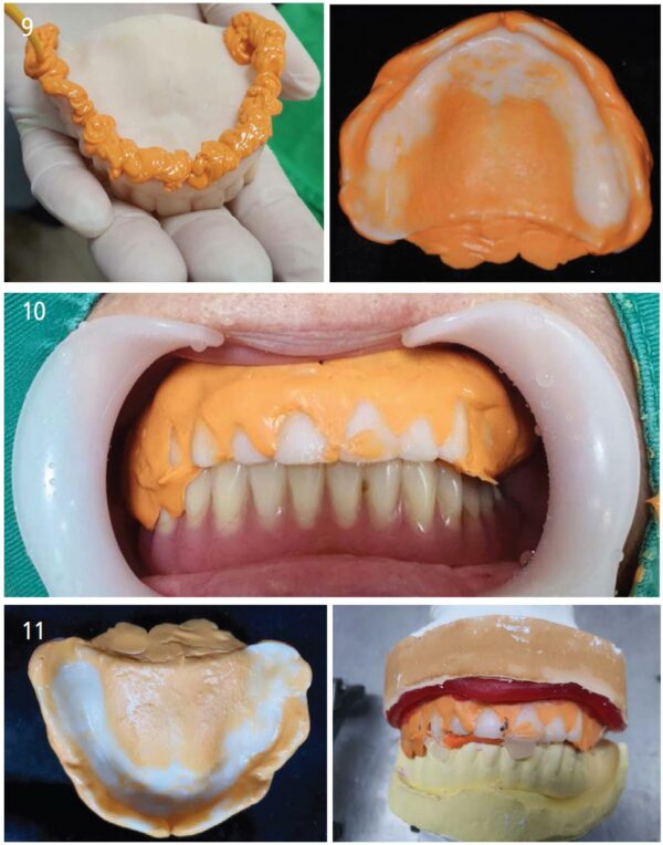 Intraoral Scanning in the Creation and Application of Duplicate ...