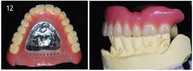Intraoral Scanning in the Creation and Application of Duplicate ...
