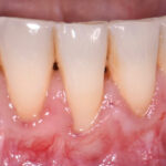 gingival-recession-fig-7 - Decisions in Dentistry