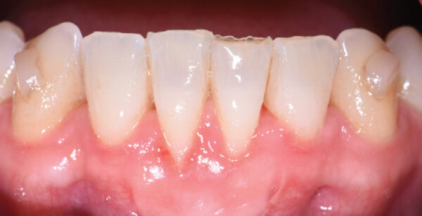 Understanding And Managing Gingival Recession - Decisions in Dentistry