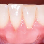 gingival-recession-fig-7 - Decisions in Dentistry