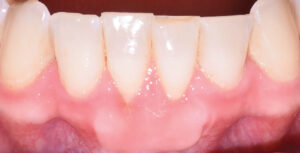 Understanding And Managing Gingival Recession - Decisions in Dentistry