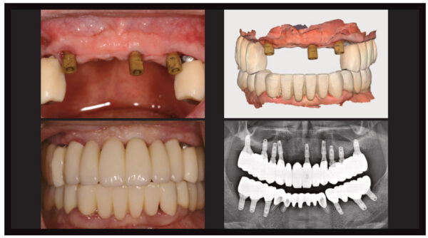 Digital Dentistry Begins With Intraoral Scanning - Decisions in Dentistry