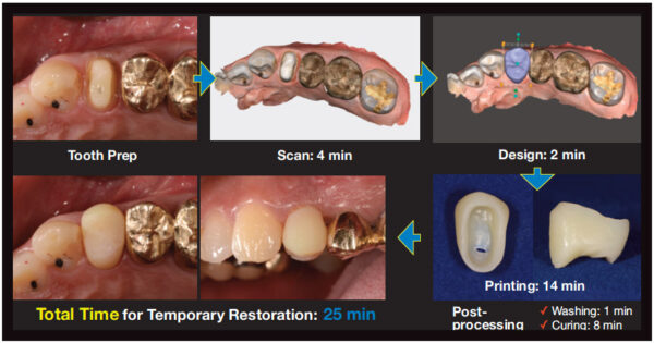 Digital Dentistry Begins With Intraoral Scanning - Decisions in Dentistry