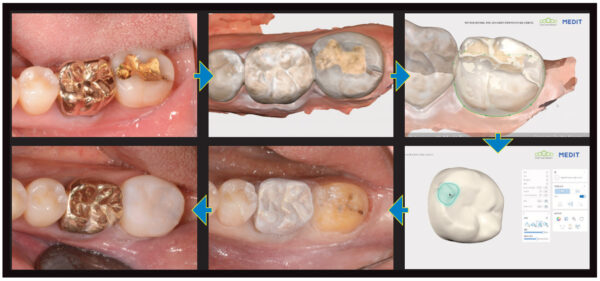 Digital Dentistry Begins With Intraoral Scanning - Decisions in Dentistry