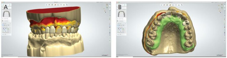 Rapid Fabrication of an Immediate Interim Removable Partial Denture ...