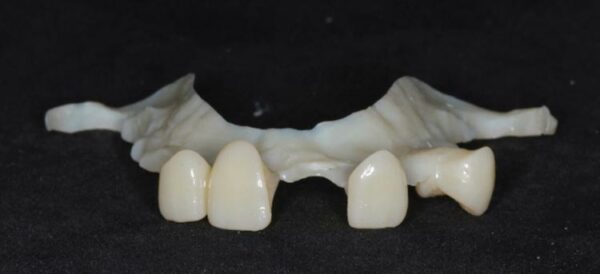 Rapid Fabrication of an Immediate Interim Removable Partial Denture ...
