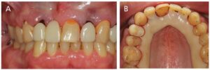 Rapid Fabrication of an Immediate Interim Removable Partial Denture ...