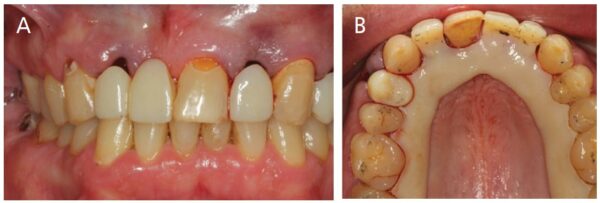 Rapid Fabrication of an Immediate Interim Removable Partial Denture ...