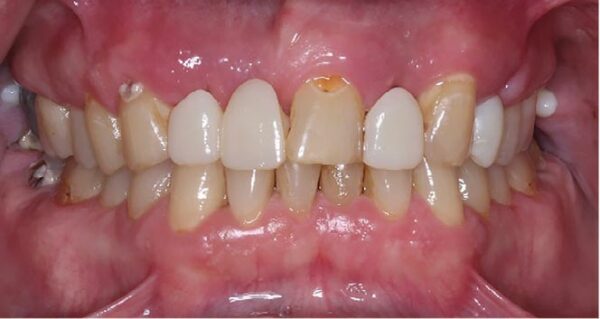 Rapid Fabrication of an Immediate Interim Removable Partial Denture ...