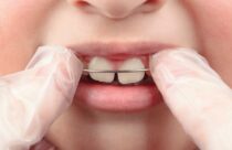 10 Steps to Rubber Dam Isolation in Restorative Therapy