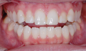 Smile Design Cases Start With Imaging and Wax-Ups - Decisions in Dentistry