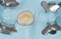 10 Steps to Rubber Dam Isolation in Restorative Therapy