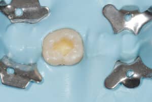 Single-Shade Composite Offers Excellent Esthetics - Decisions in Dentistry