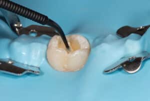 Single-Shade Composite Offers Excellent Esthetics - Decisions in Dentistry